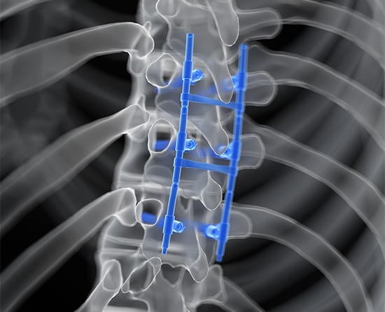 Lumbar Fusion | Houston, TX | Modern Spine