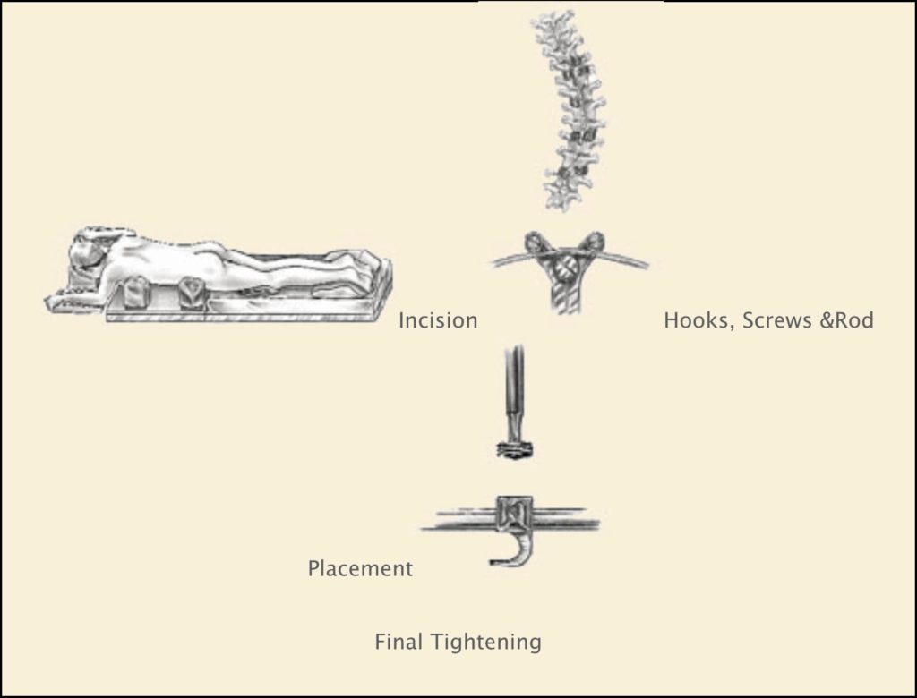 Posterior Approach Houston, TX | Modern Spine